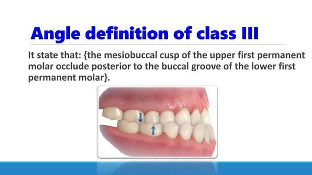 Class iii malocclusion | PPTX