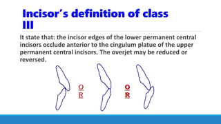 Class iii malocclusion | PPTX