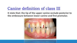Class iii malocclusion | PPT