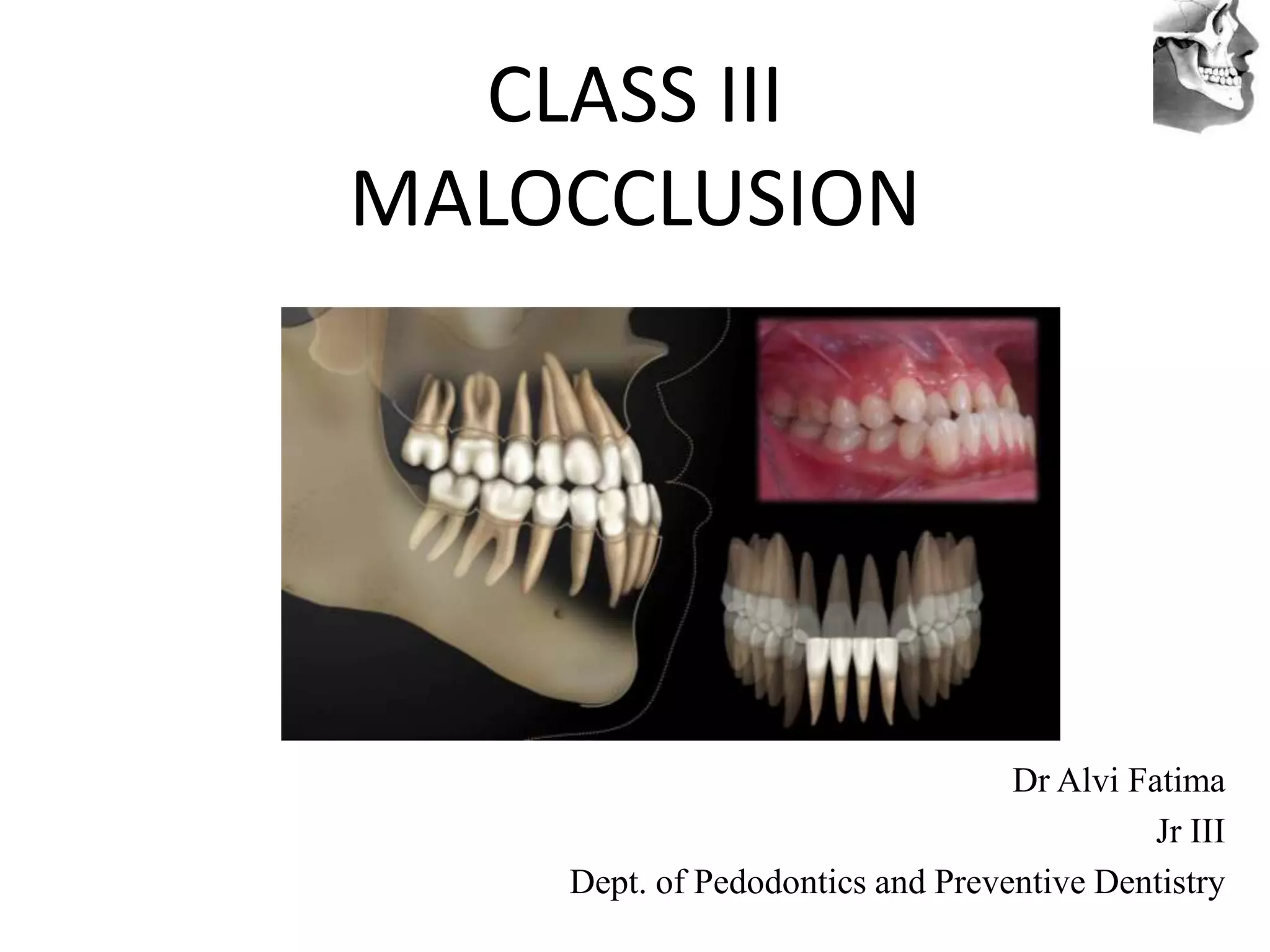 Class iii malocclusion | PPT