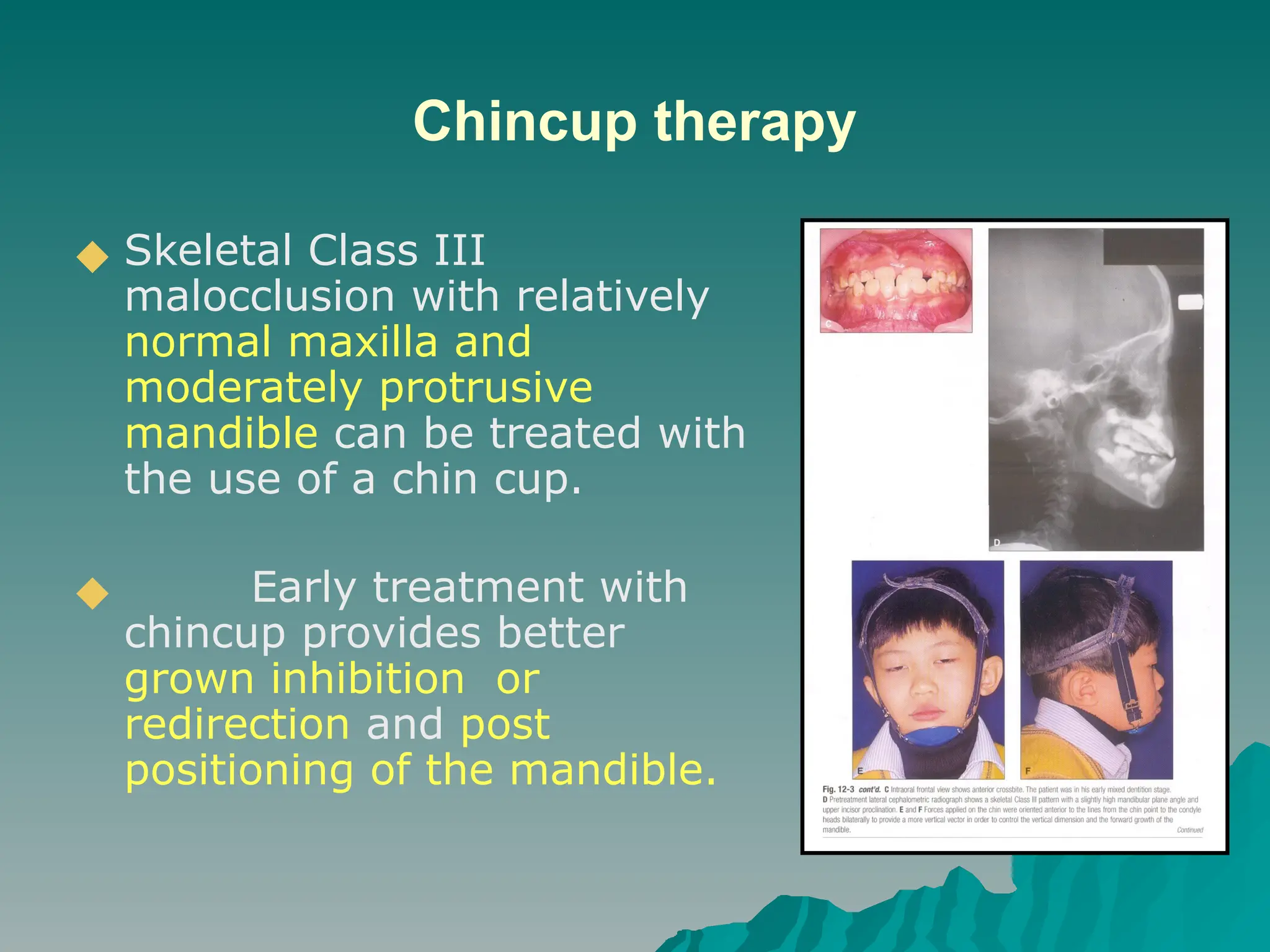 CLASS III MALOCCLUSION diagnosis and treatment.pptx