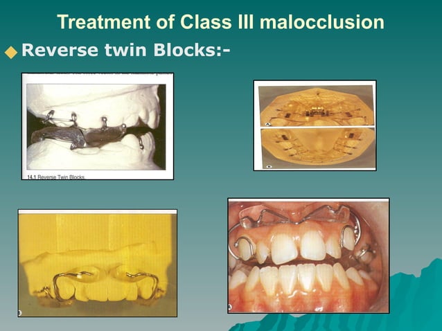 CLASS III MALOCCLUSION diagnosis and treatment.pptx