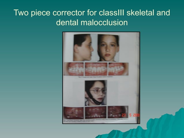 CLASS III MALOCCLUSION diagnosis and treatment.pptx