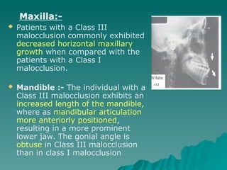 CLASS III MALOCCLUSION IN ORTHODONTICS .pptx