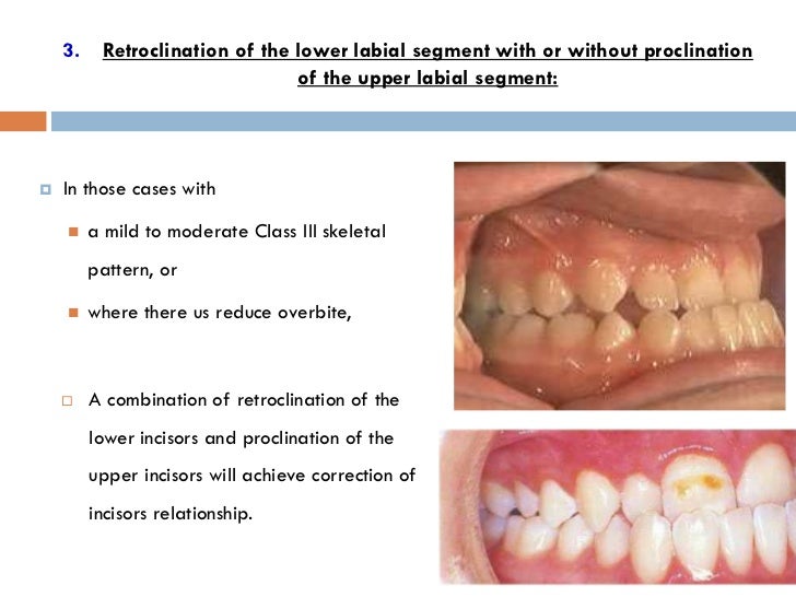 Class III Malocclusion - Dr. Nabil Al-Zubair