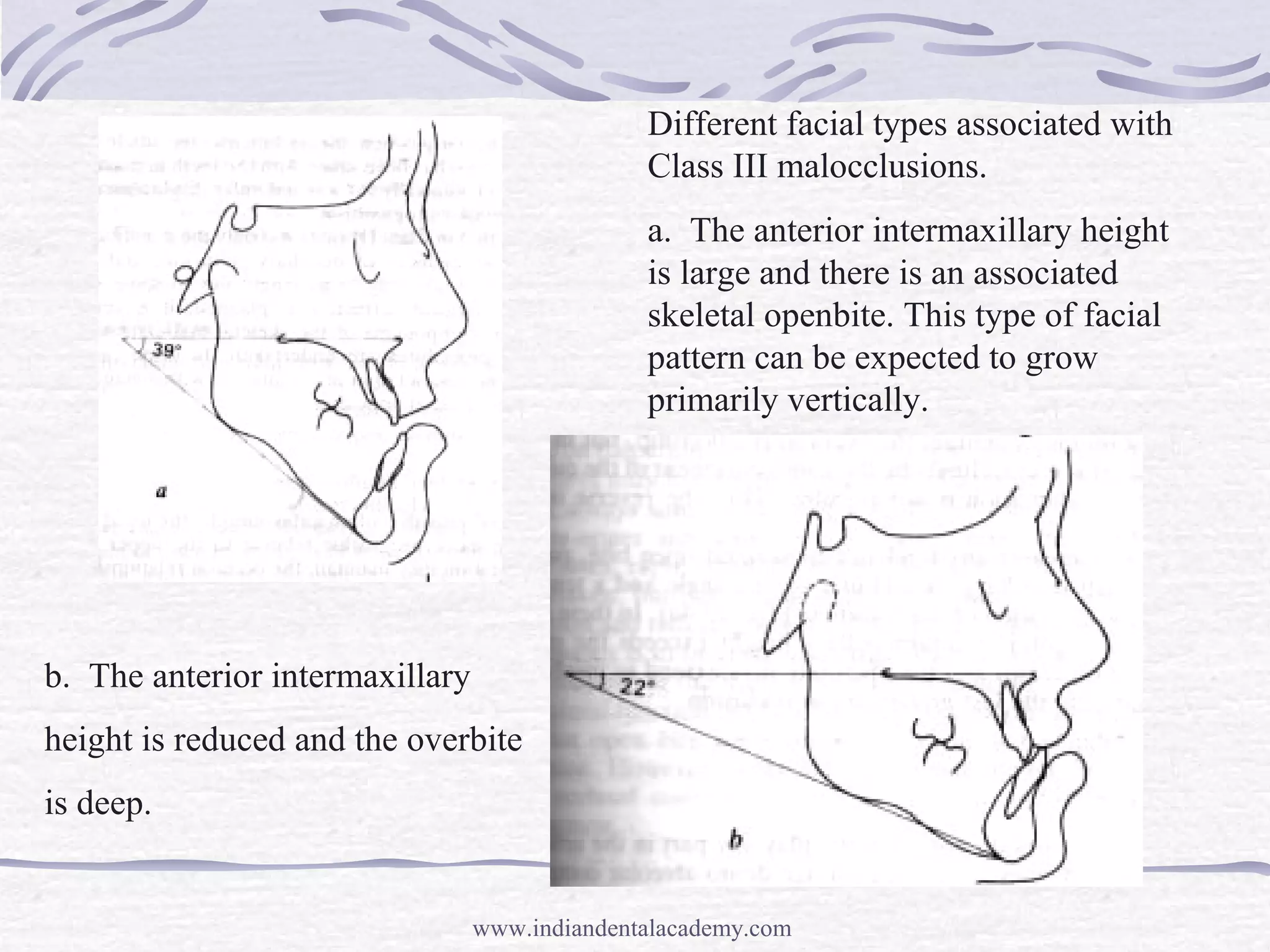Class 3 malocclusions | PPT