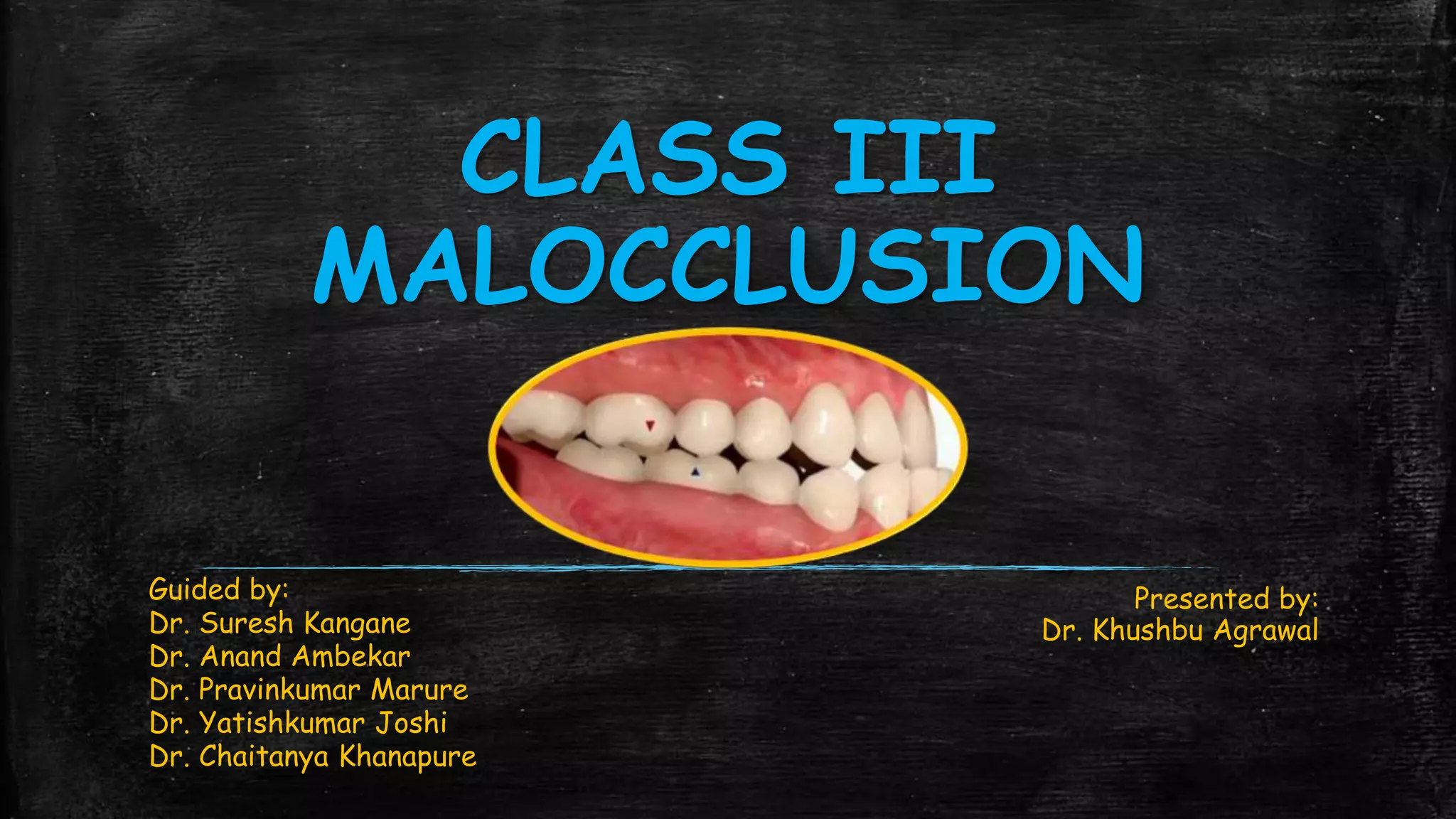 Class III malocclusion seminar | PPTX