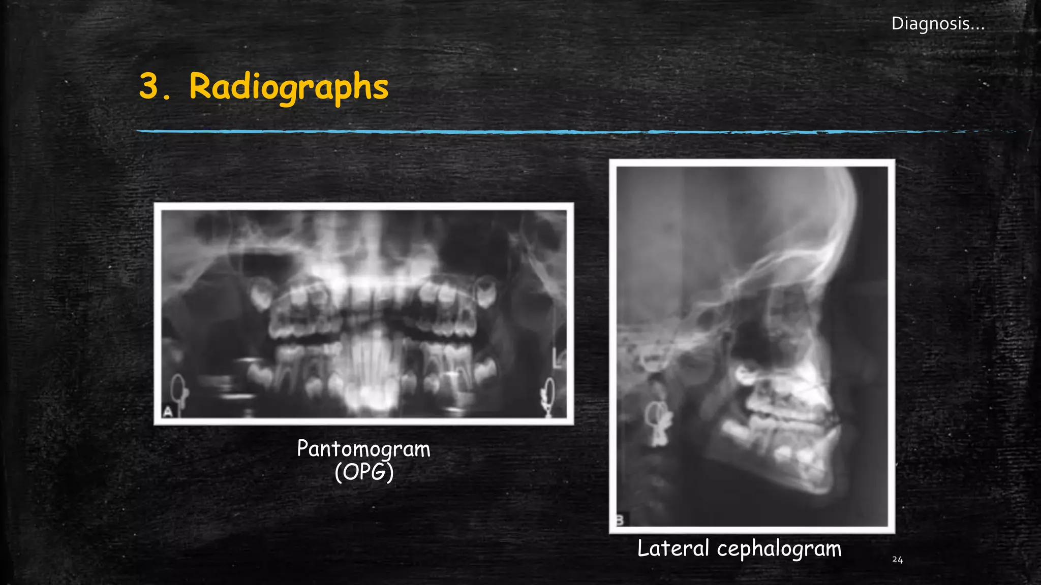 Class III malocclusion seminar | PPTX