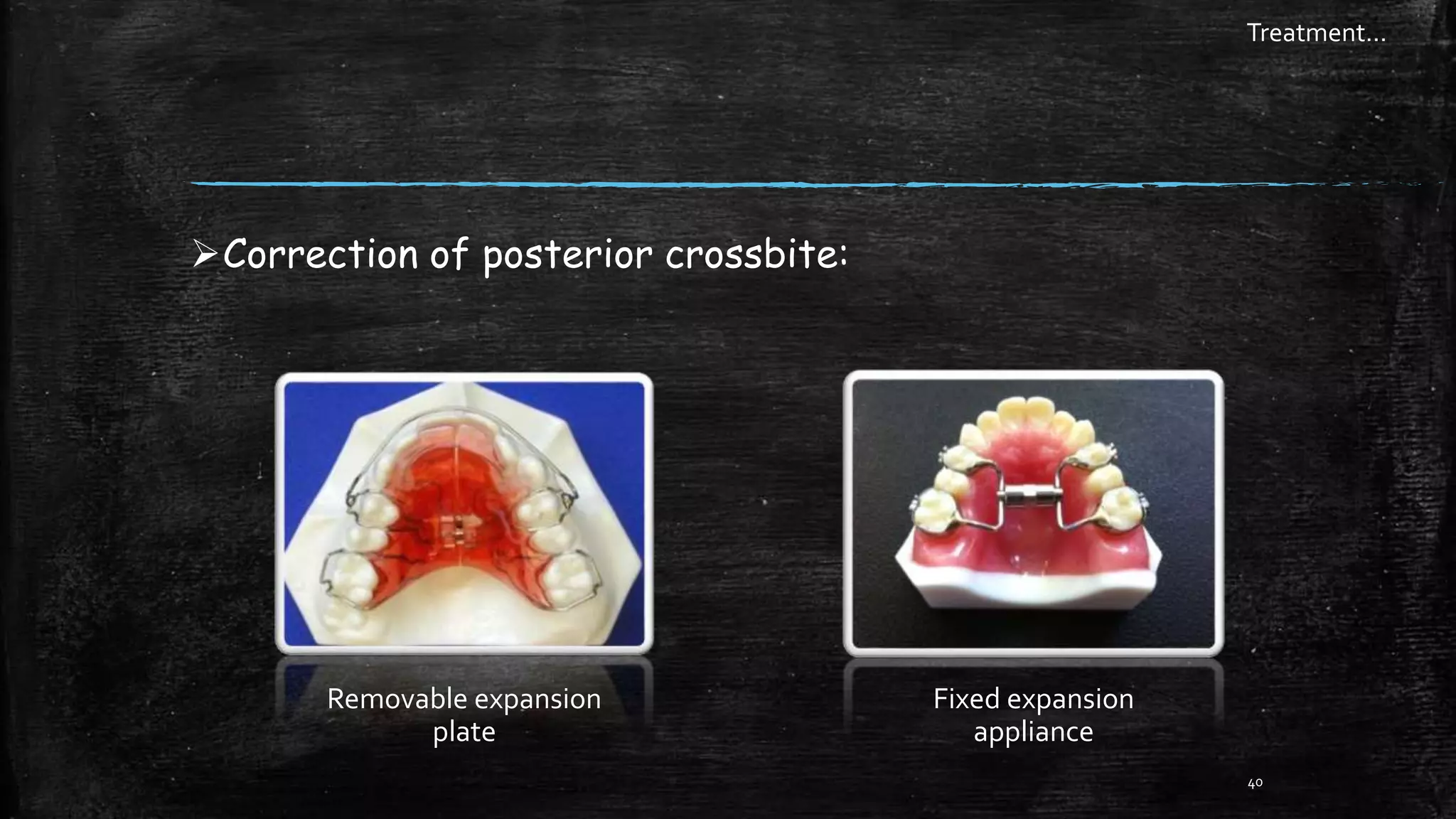 Class III malocclusion seminar | PPTX