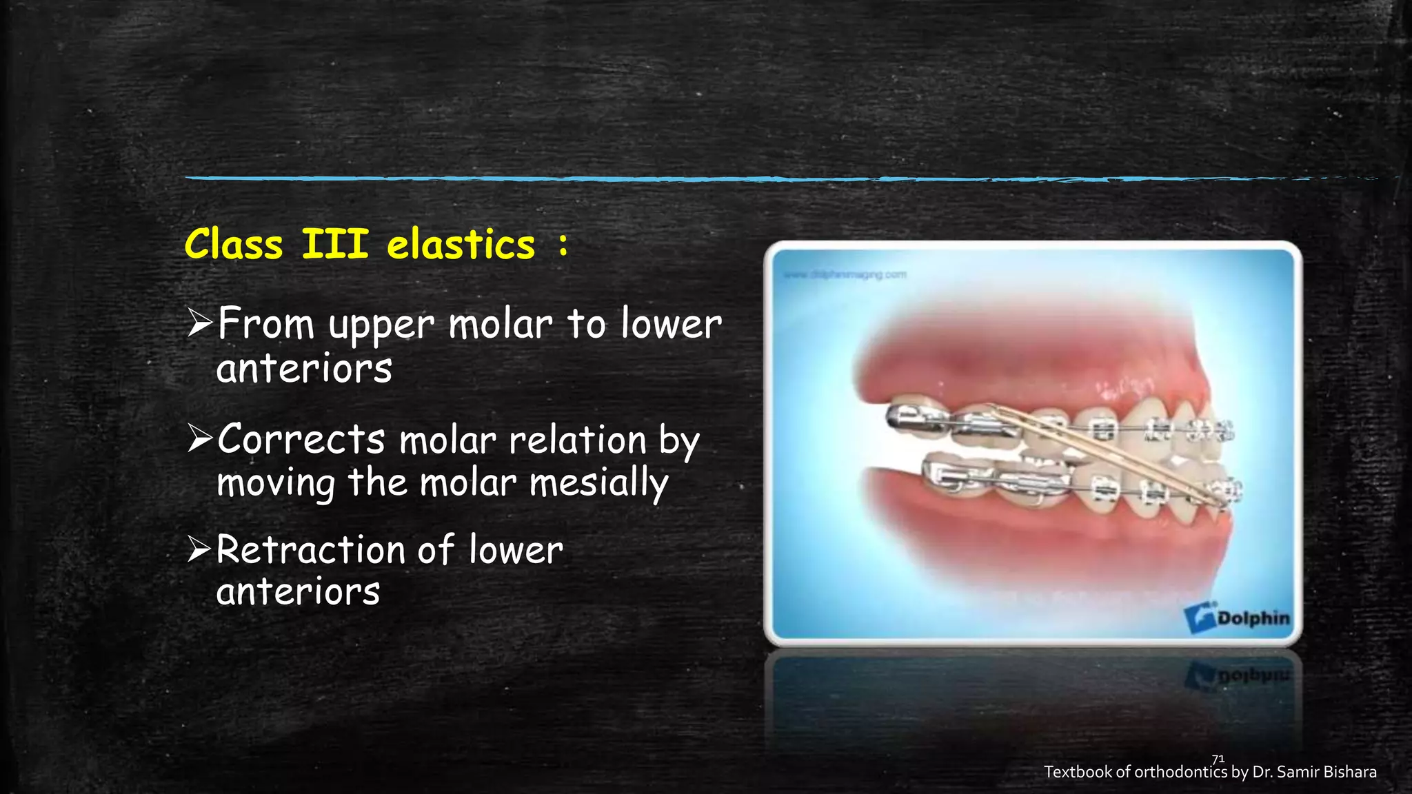 Class III malocclusion seminar | PPTX