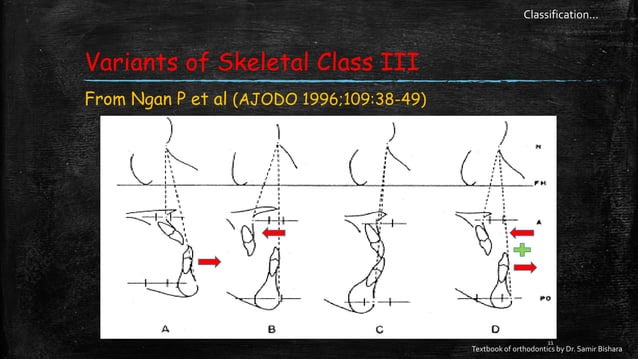 Class III malocclusion seminar | PPTX | Dental Health | Diseases and ...