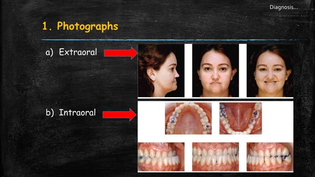 Class III malocclusion seminar | PPTX | Dental Health | Diseases and ...