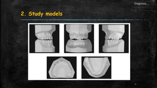 Class III malocclusion seminar | PPTX
