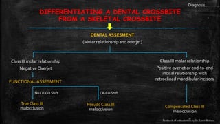 Class III malocclusion seminar | PPTX