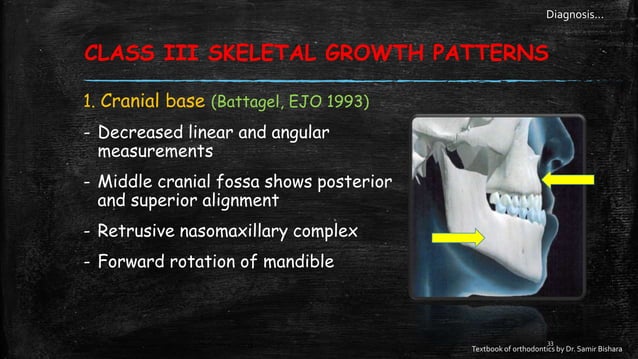 Class III malocclusion seminar | PPTX | Dental Health | Diseases and ...