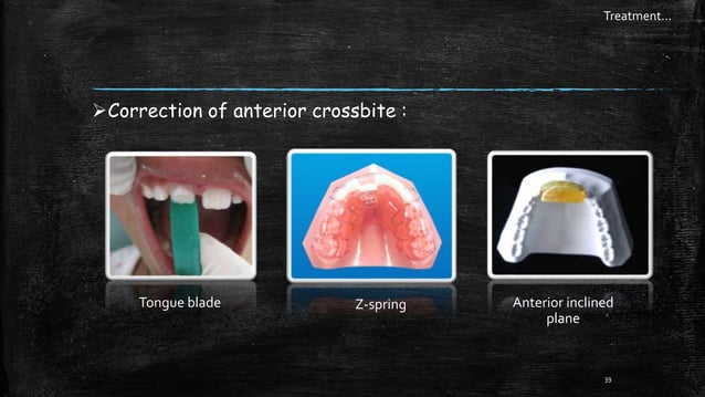 Class III malocclusion seminar | PPTX | Dental Health | Diseases and ...