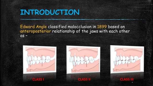 Class III malocclusion seminar | PPTX | Dental Health | Diseases and ...