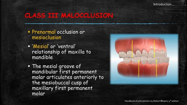 Class III malocclusion seminar | PPTX | Dental Health | Diseases and ...