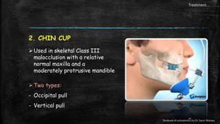 Class III malocclusion seminar | PPTX