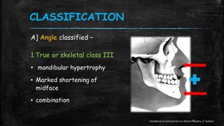 Class III malocclusion seminar | PPTX