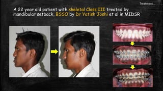 Class III malocclusion seminar | PPTX