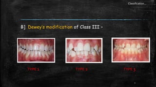 Class III malocclusion seminar | PPTX