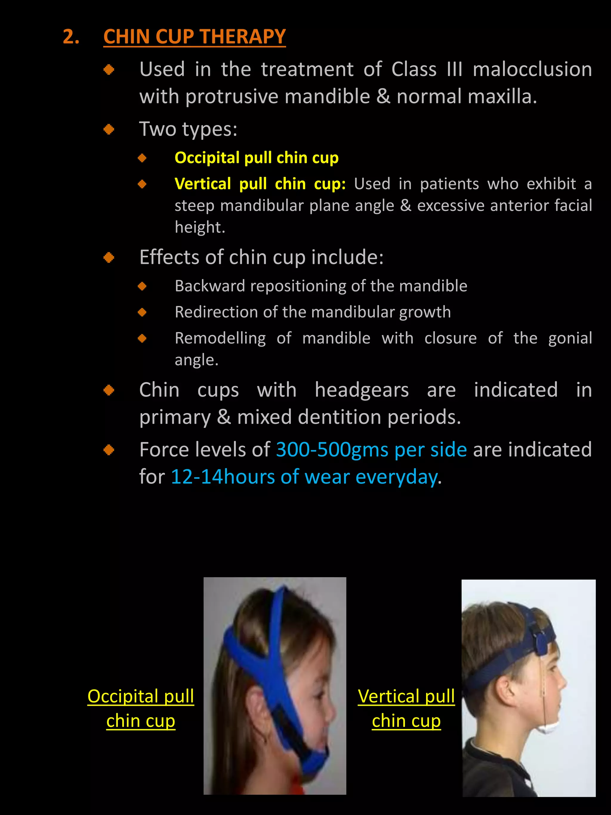 Class III Malocclusion | PPTX
