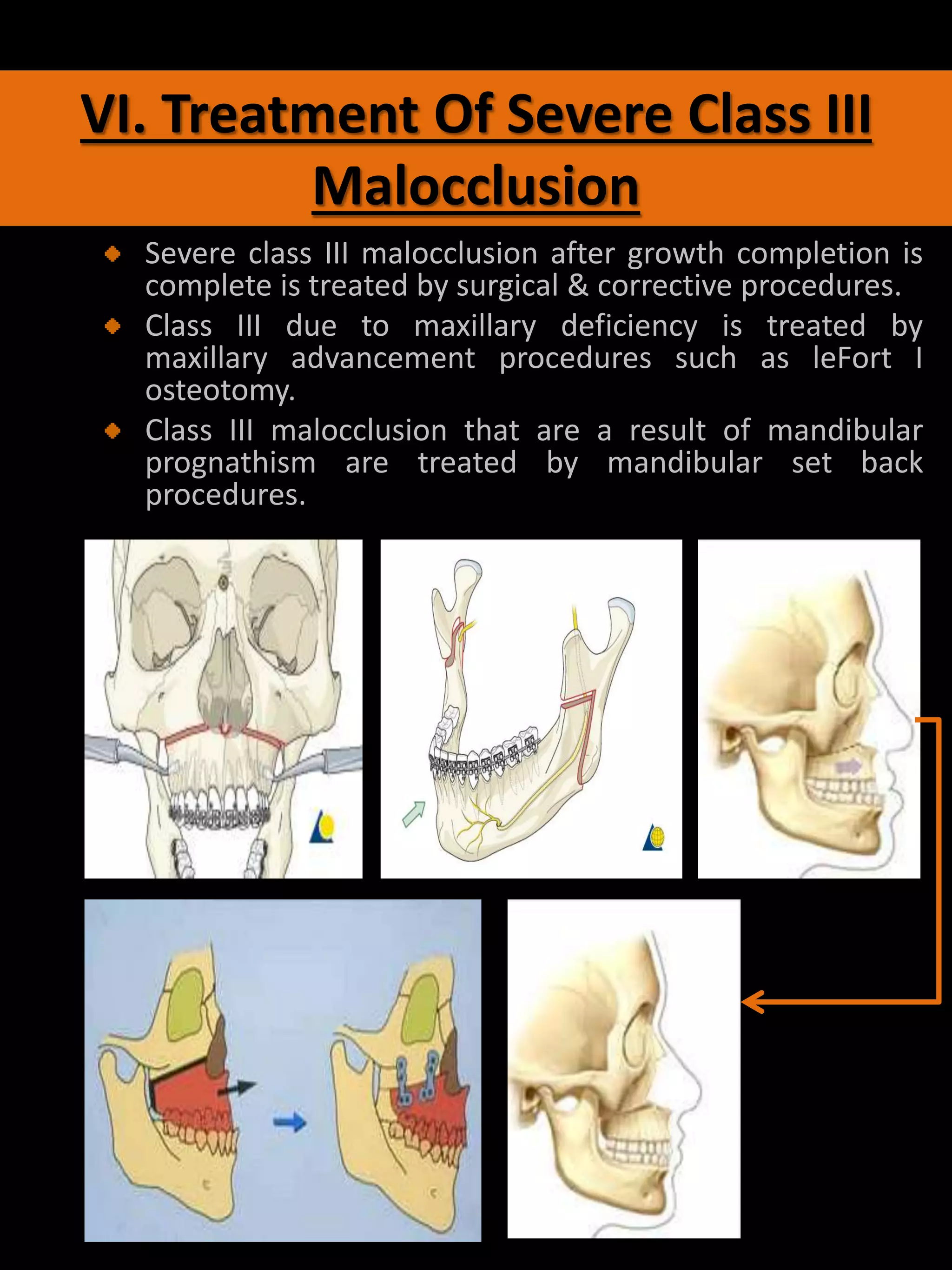 Class III Malocclusion | PPTX