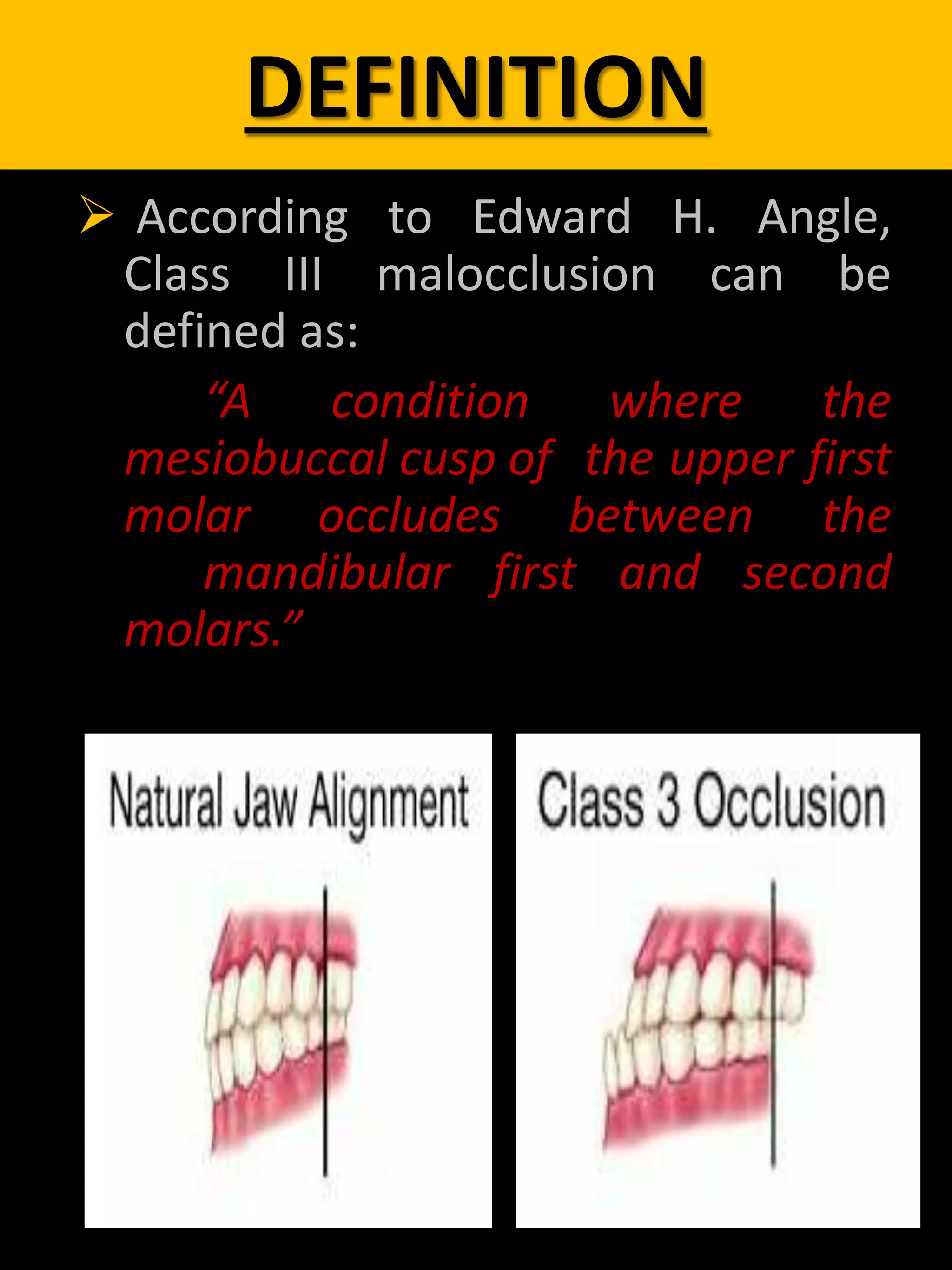Class III Malocclusion | PPTX