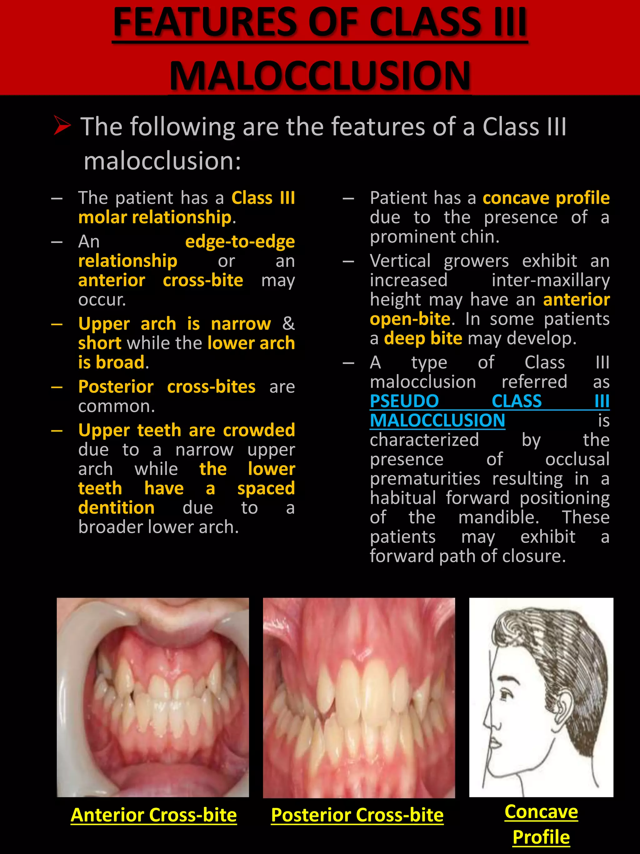 Class III Malocclusion | PPTX