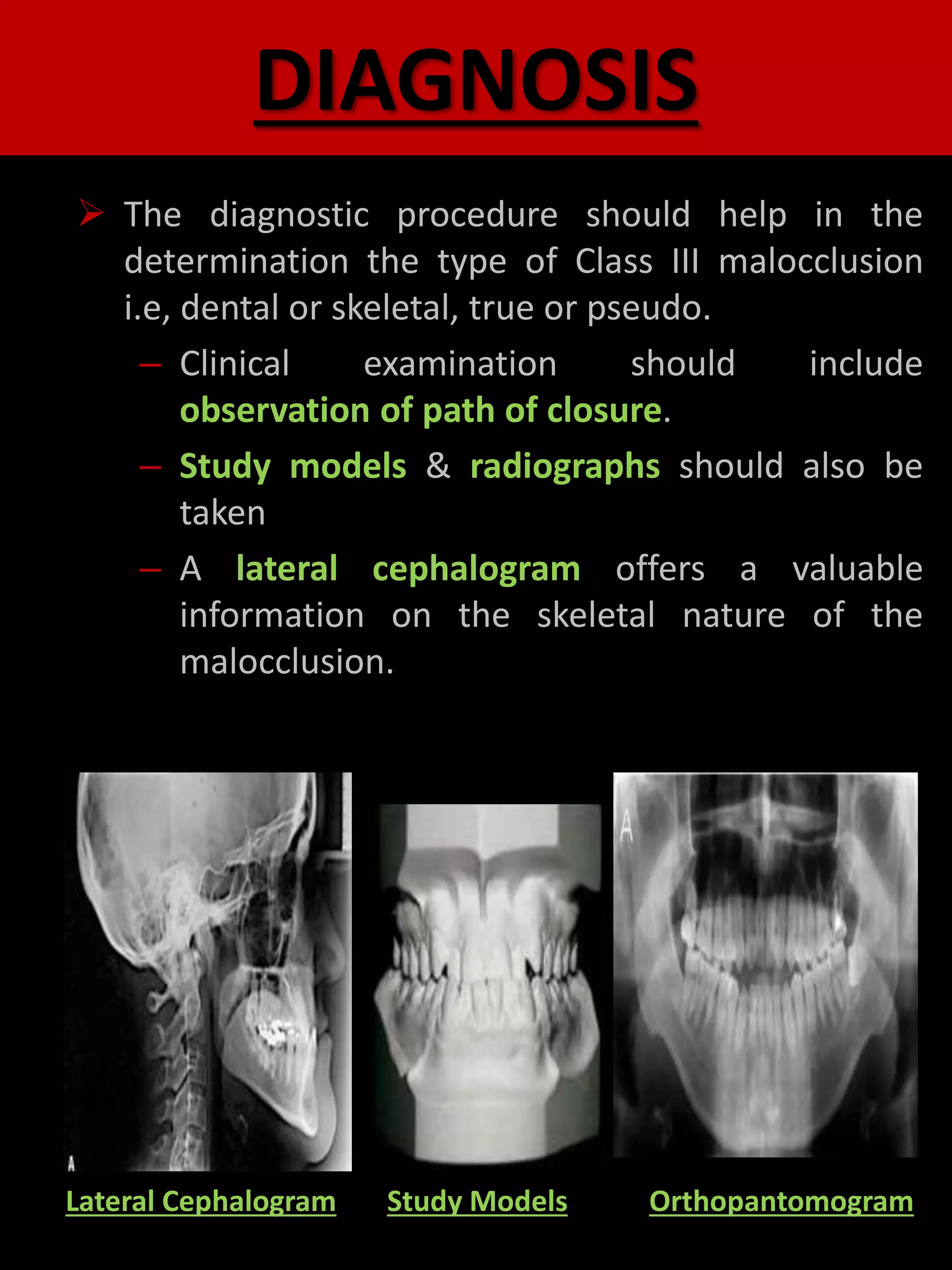 Class III Malocclusion | PPTX