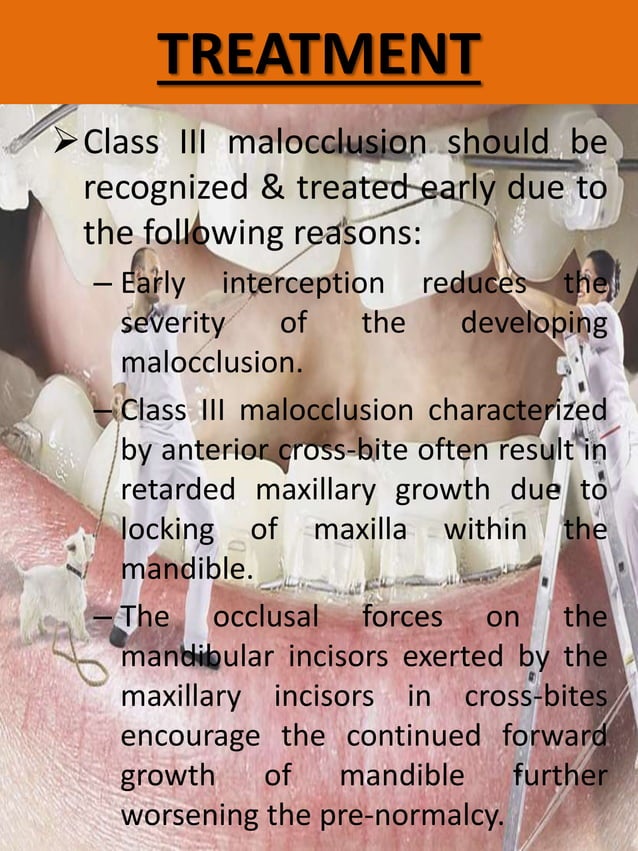 Class III Malocclusion | PPTX