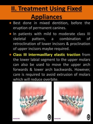 Class III Malocclusion | PPTX