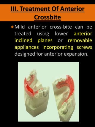 Class III Malocclusion | PPTX