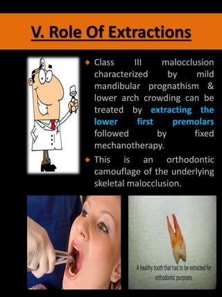 Class III Malocclusion | PPTX