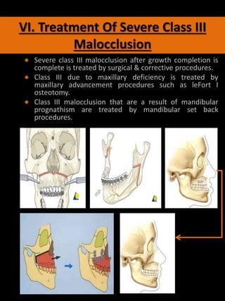 Class III Malocclusion | PPTX