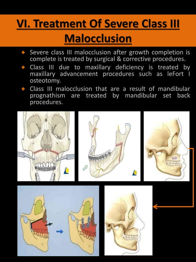 Class III Malocclusion | PPTX
