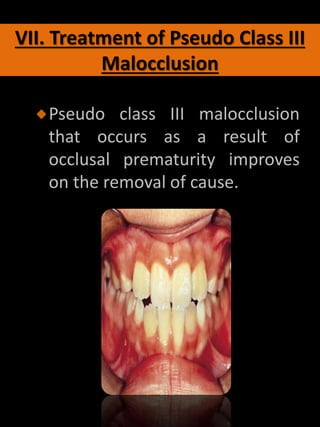 Class III Malocclusion | PPTX
