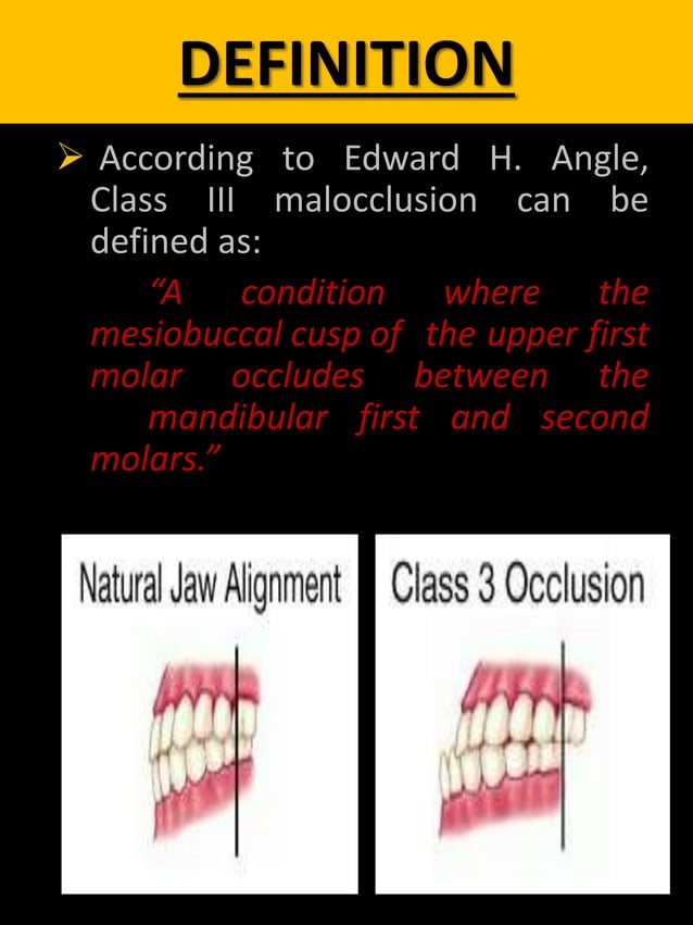 Class III Malocclusion | PPTX