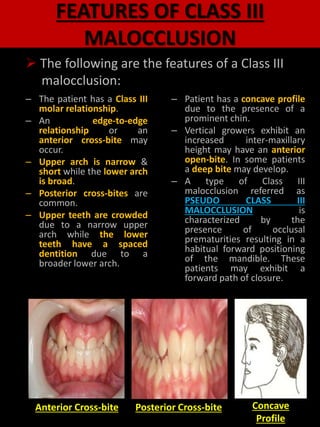 Class III Malocclusion | PPTX