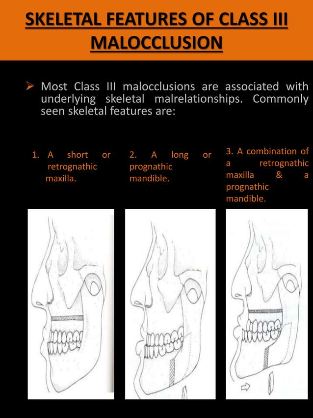 Class III Malocclusion | PPTX