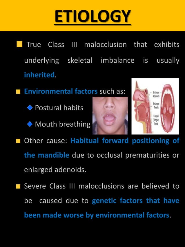 Class III Malocclusion | PPTX
