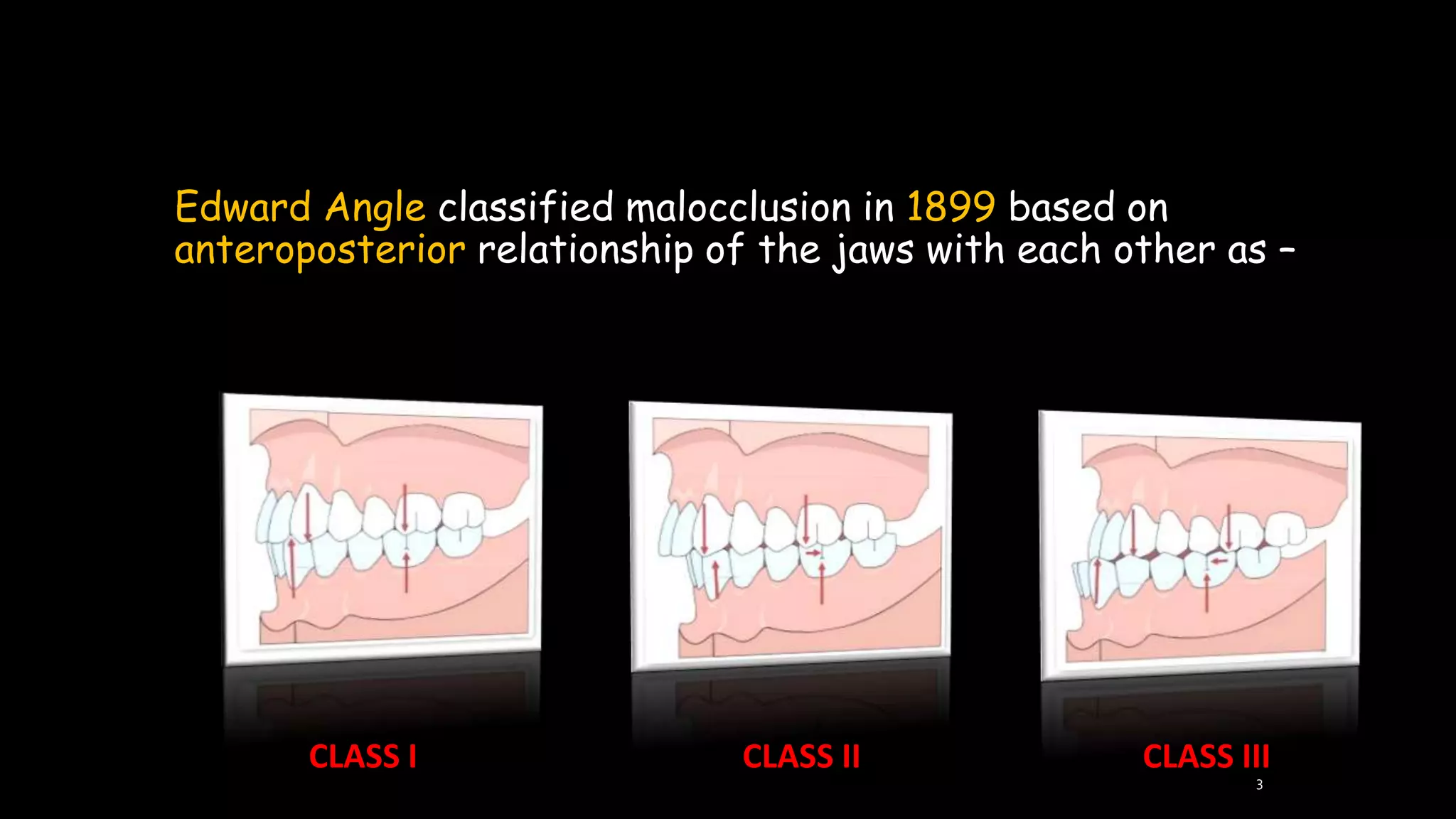 CLASS 3 MALOCCLUSION(Dr.PANCHAMI MARISH | PPTX