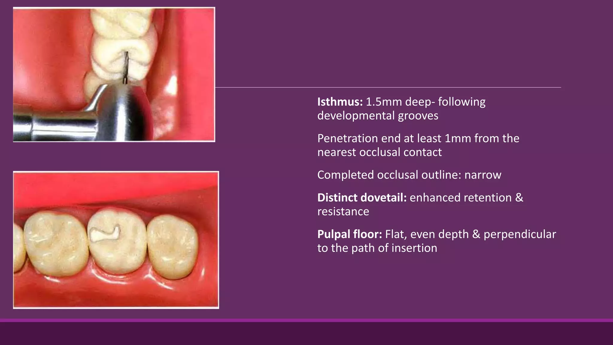 Class II Inlay | PPTX
