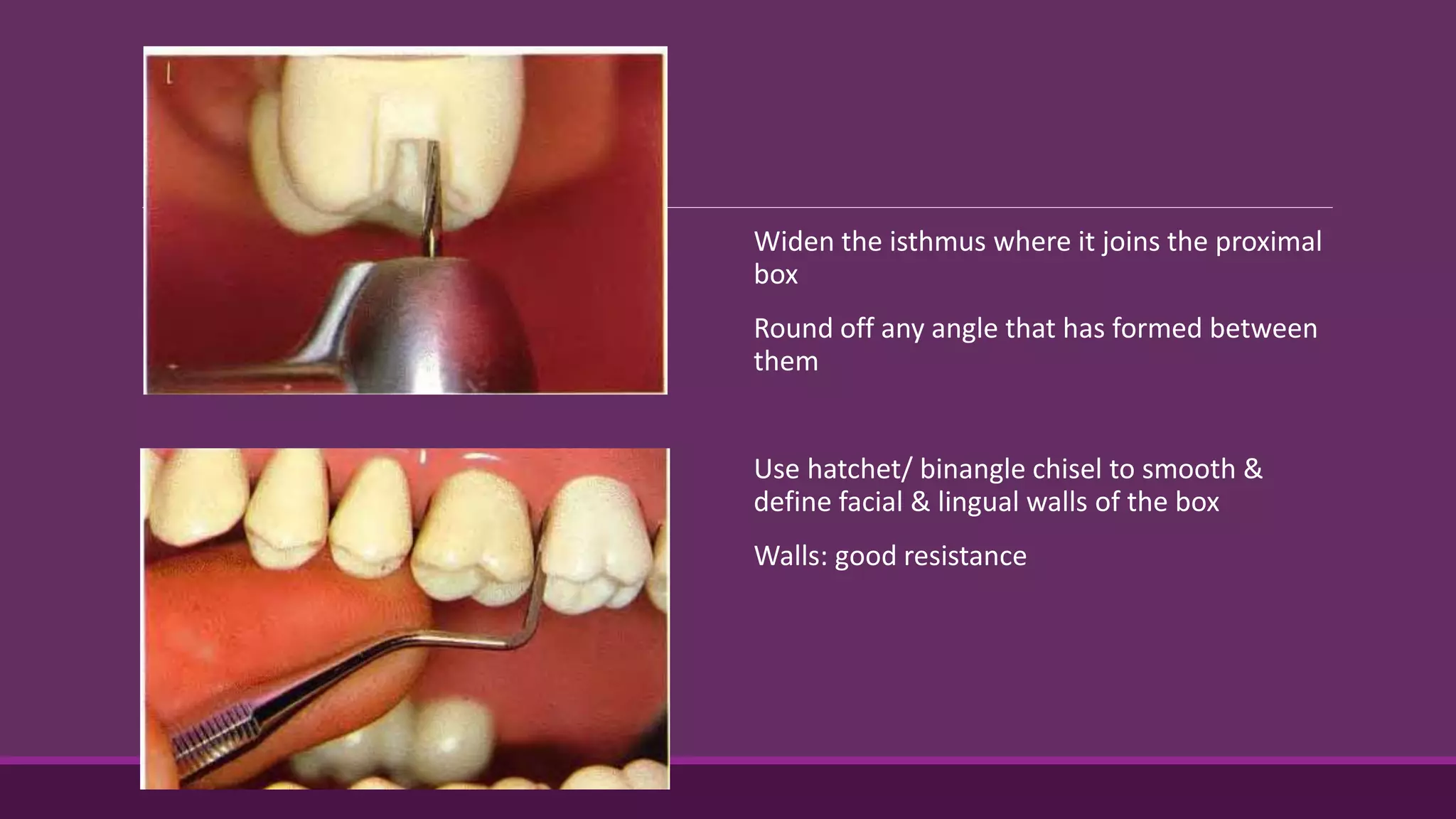 Class II Inlay | PPTX