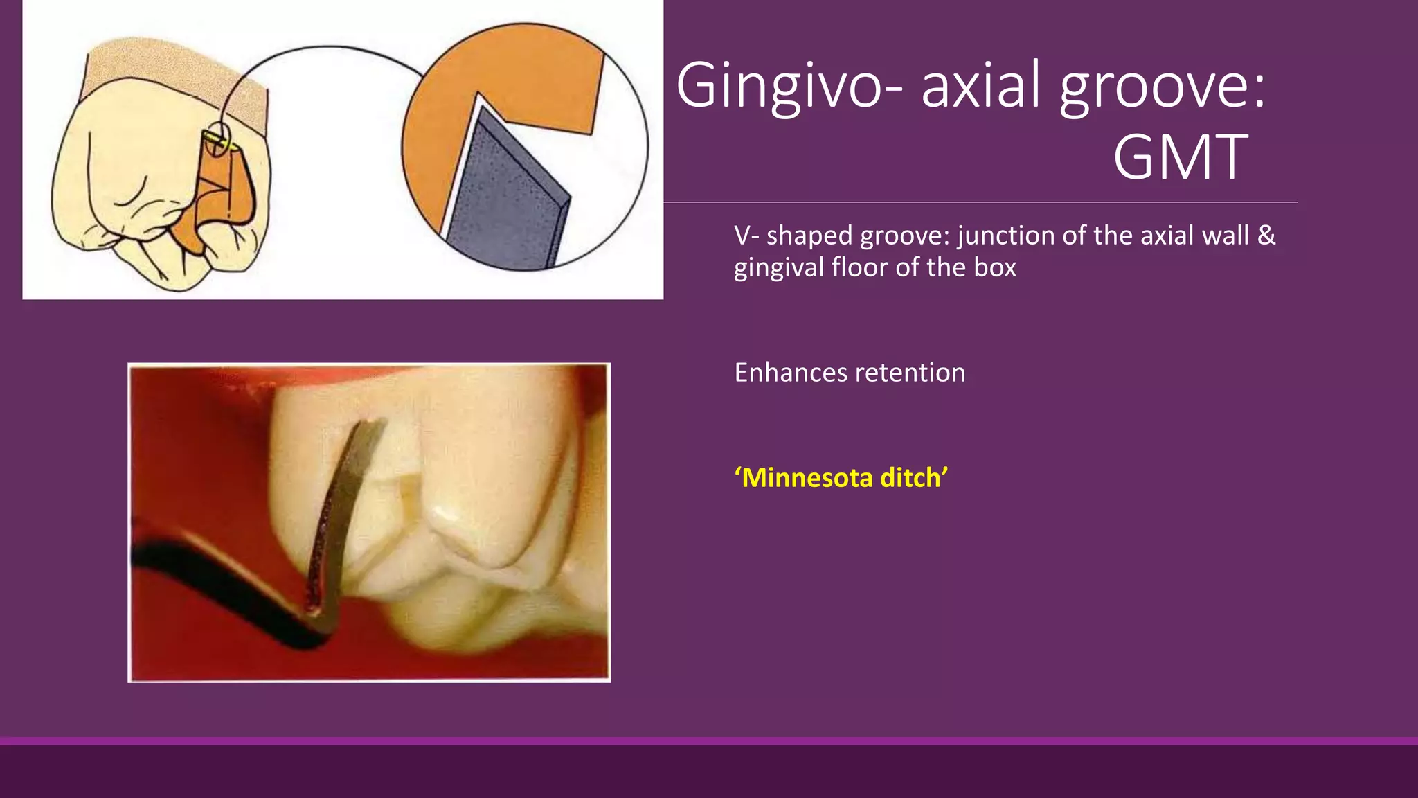 Class II Inlay | PPTX