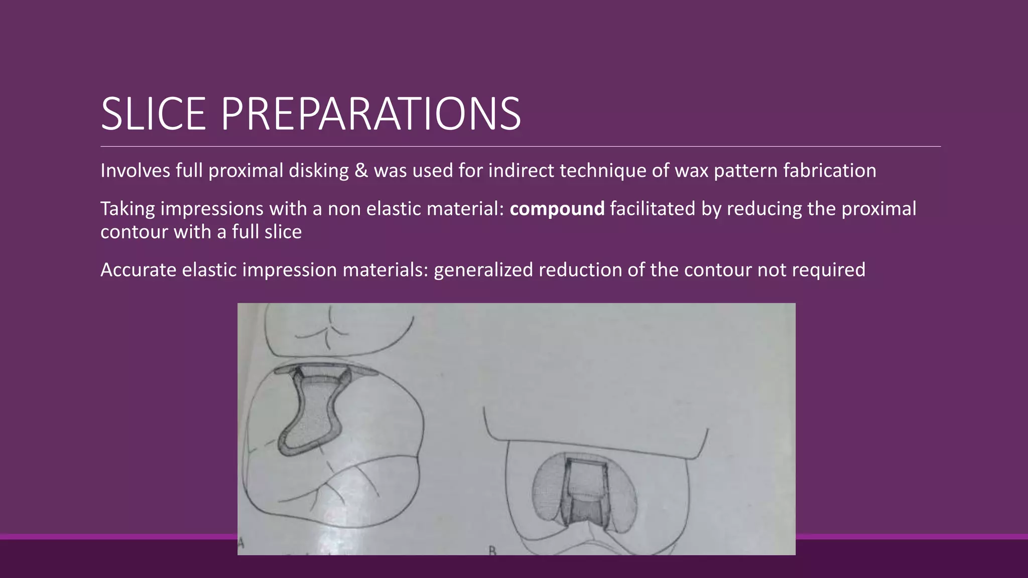 Class II Inlay | PPTX