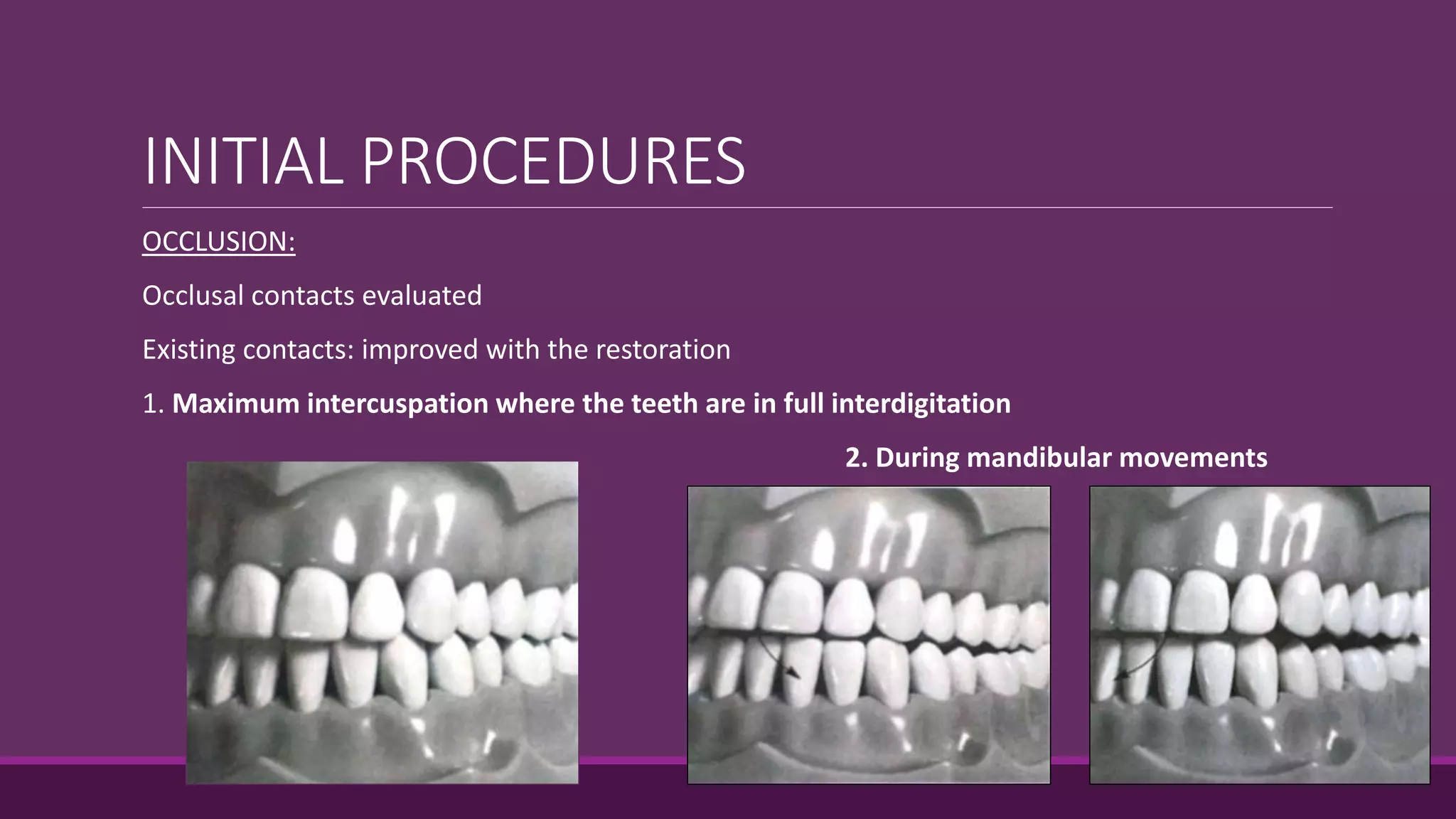 Class II Inlay | PPTX