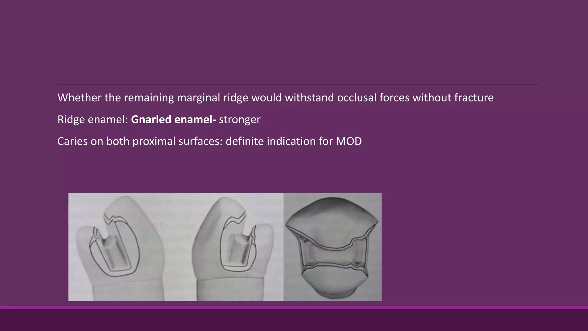 Class II Inlay | PPTX