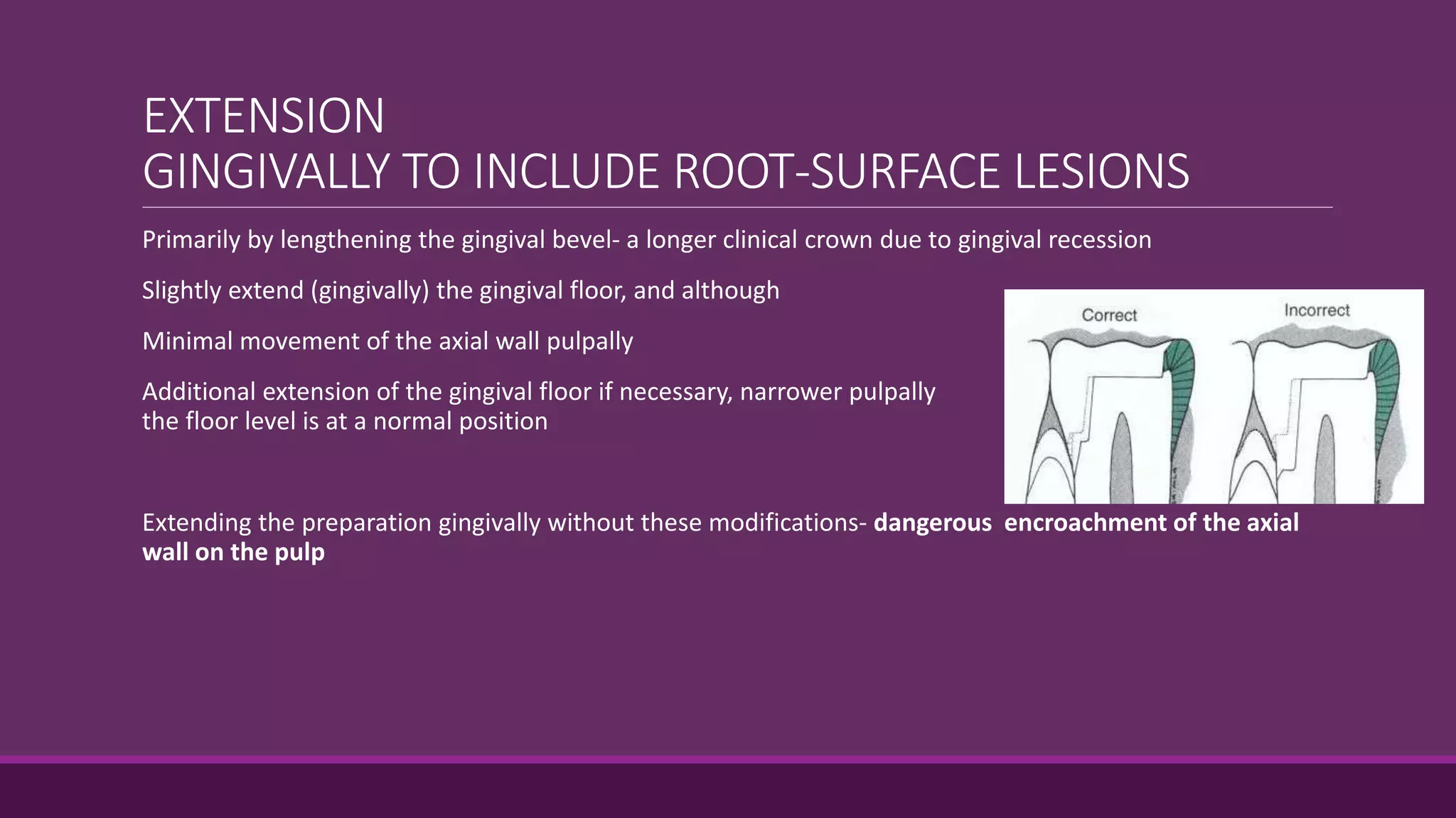 Class II Inlay | PPTX